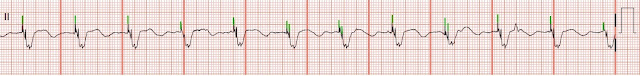 EKG Rhythm Strip Quiz 56: Paced Rhythms