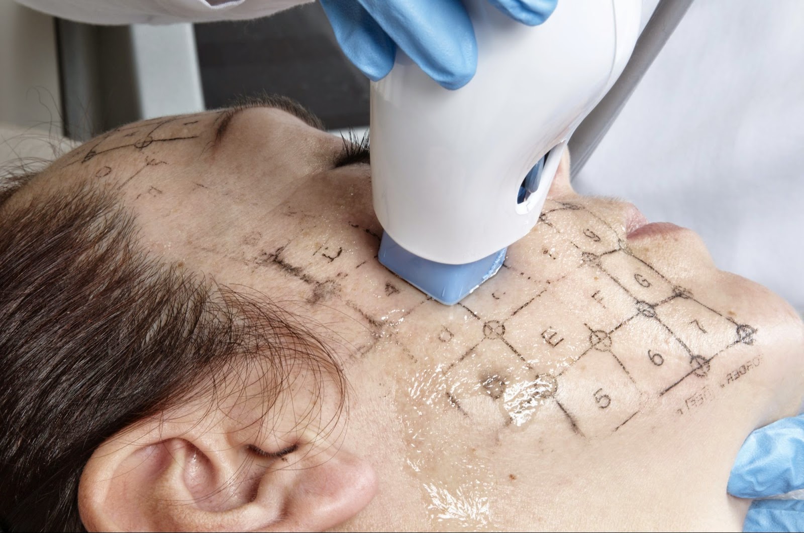 That Bong Girl: Thermage treatment is now available with all top ...