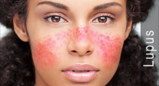 Cara Mengobati Penyakit Lupus | AHLINYA PENGOBATAN GINJAL