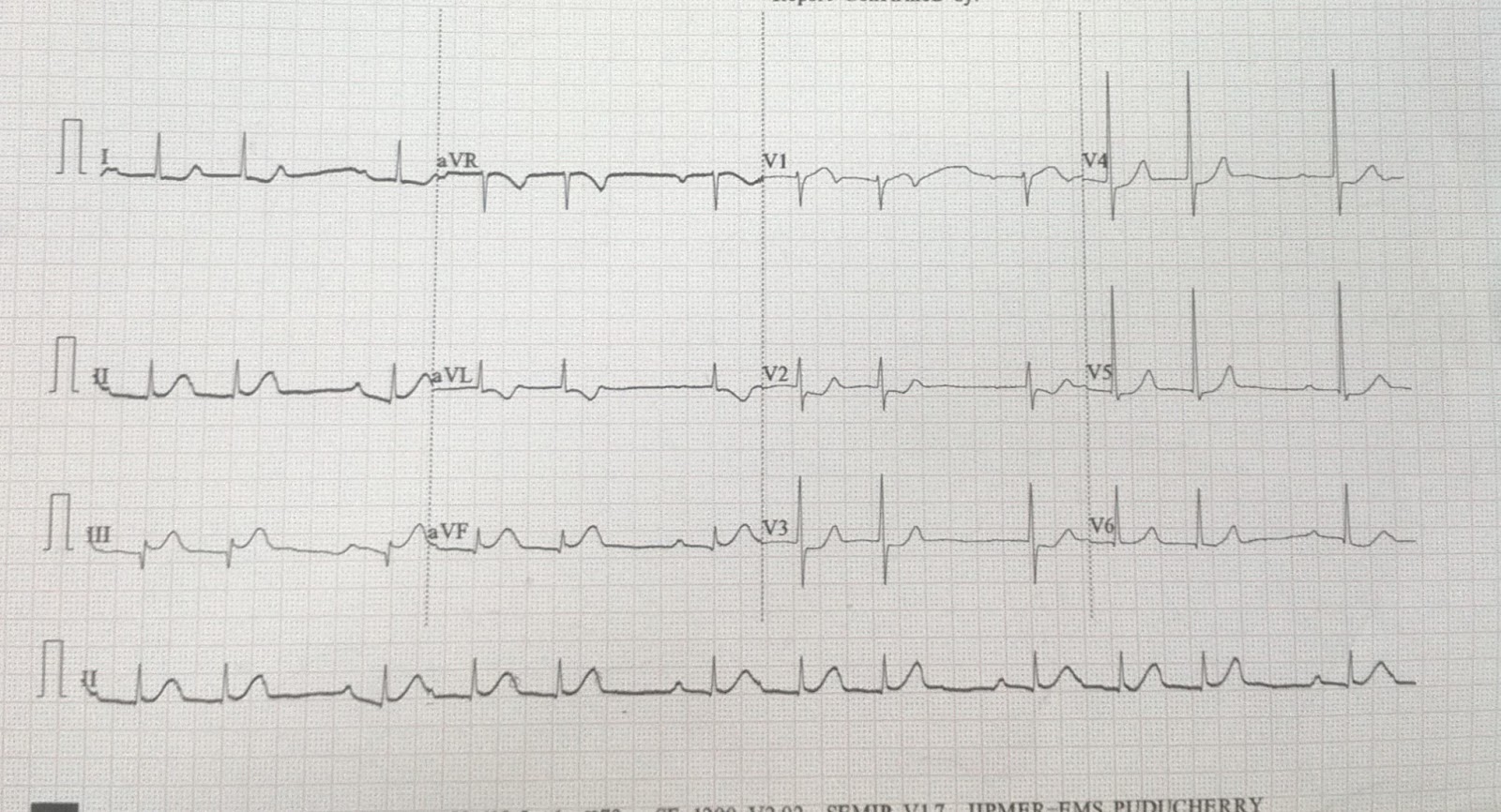Cardiology window: Inferior wall myocardial infarction presenting as ...