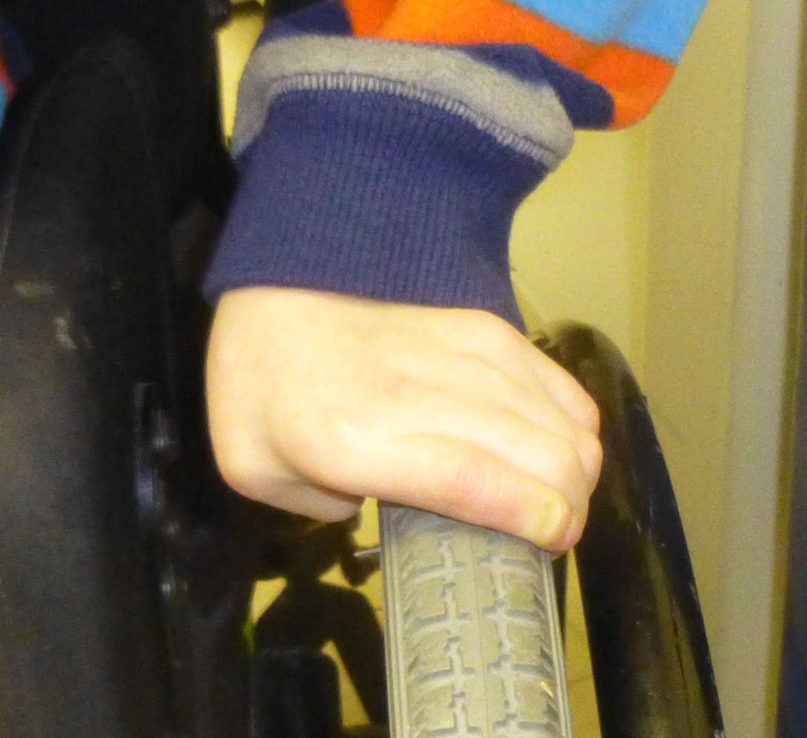 L1 Syndrome and the Thumb | Congenital Hand and Arm Differences ...