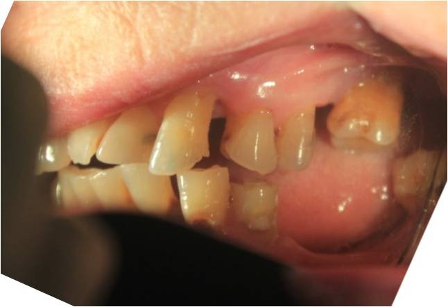 simpladent implants in india: March 2016