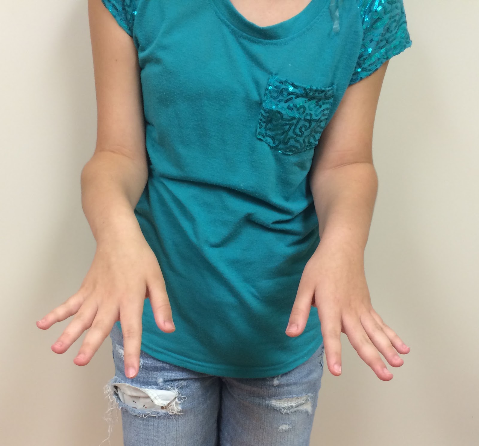 Multiple Hereditary Exostosis- Its Not Always about the X-rays ...