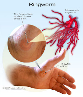 Sports and Microbes: Risks for Athletes: Tinea Corporis= Ringworm