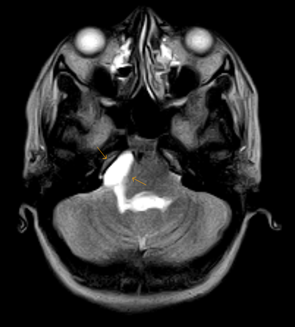 Posterior Fossa Arachnoid Cyst & Tonsillar Descent - Sumer's Radiology Blog