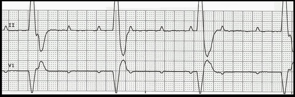 Practice Rhythm Strips 301