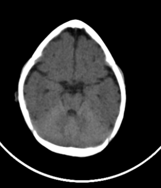 Trigonocephaly-CT - Sumer's Radiology Blog