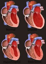 Encyclopedia of Medicine: Heart muscle disease