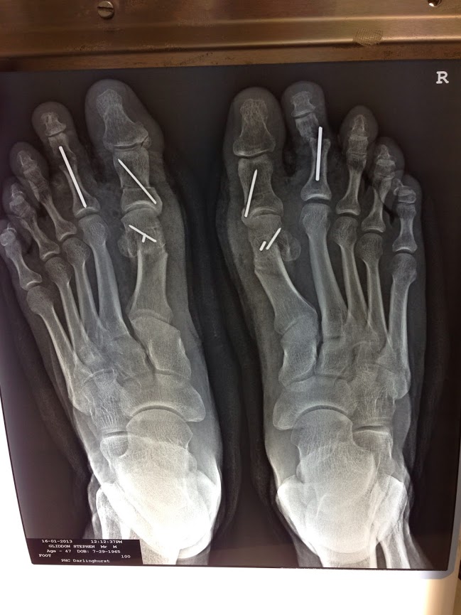 Paul Bours: #Paul #Bours - Surgical risk and complications