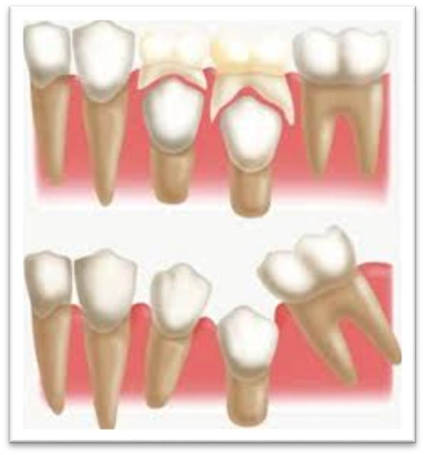 VIAGEM PELA ORTODONTIA: Leeway Space