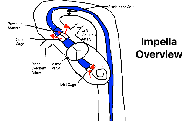 Impella Basics for Caregivers