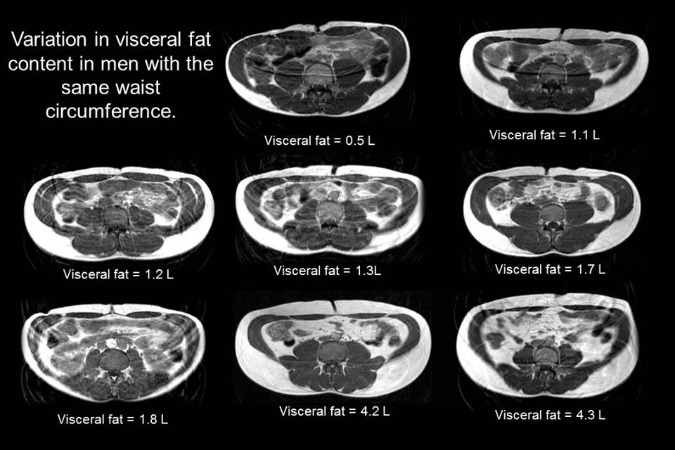 憤世嫉俗的營養人生: 以「偷肥理論」（TOFI:Thin-Outside-Fat-Inside），探討體重、體脂及BMI之迷思