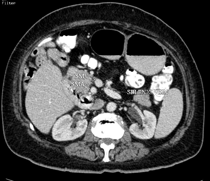 Radshare: MIDGUT MALROTATION OF ADULT