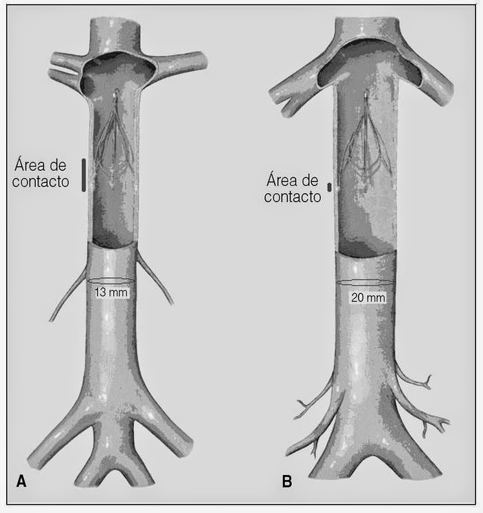 A punta de bisturí: Embolectomía Pulmonar