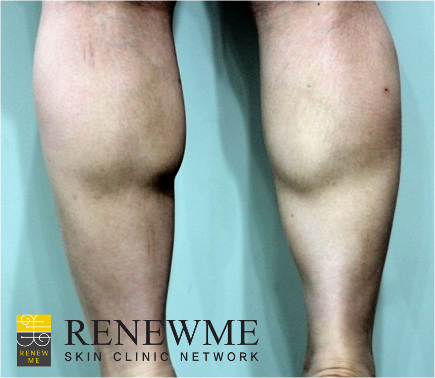 Renewme Skin Clinic: Botox Treatment for Defined Calves in Seoul Korea