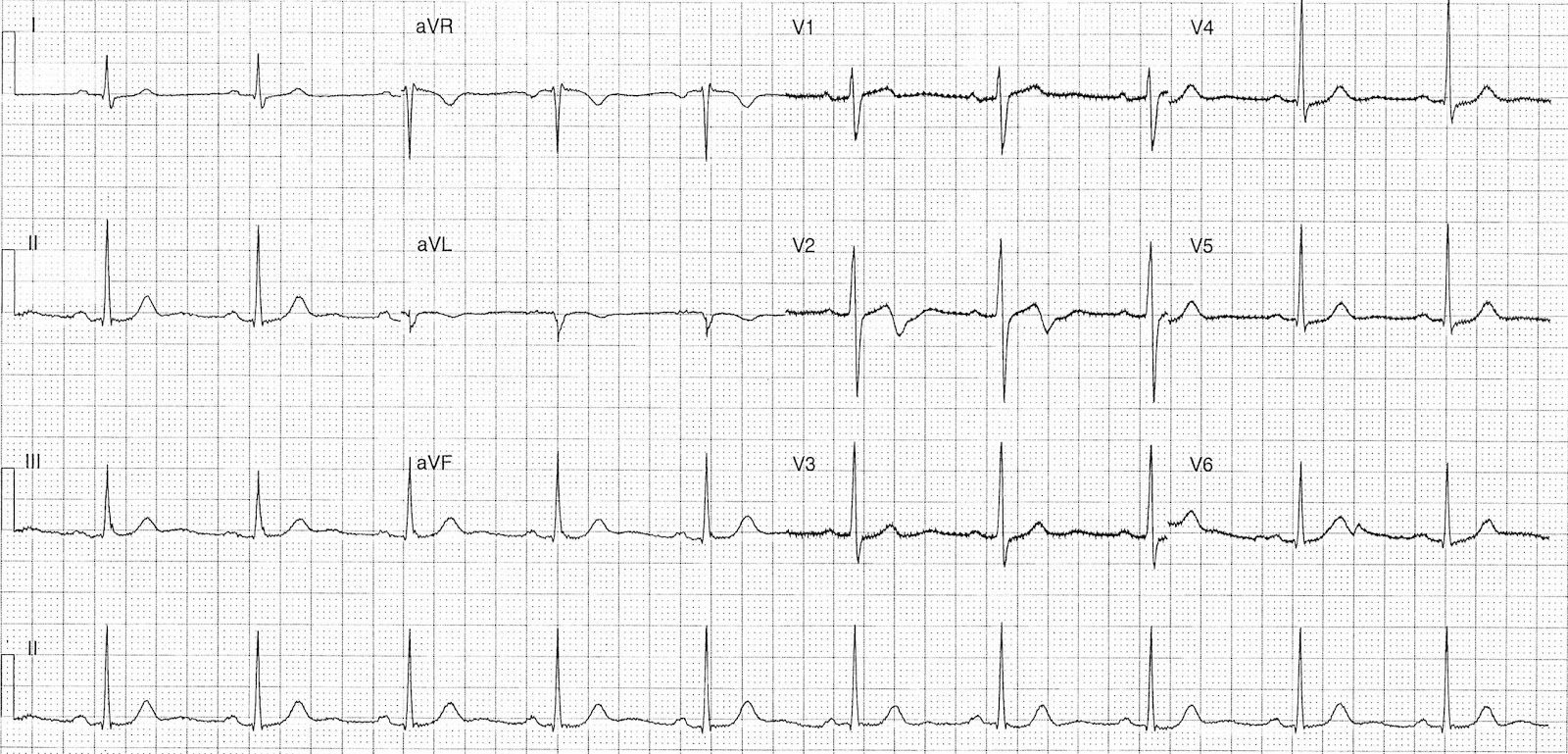 ECG of the Week: ECG of the Week - 16th January 2017 - Interpretation