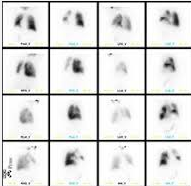 Nuclear Medicine Exams Explained - For The Patient: What Is A VQ Scan ...
