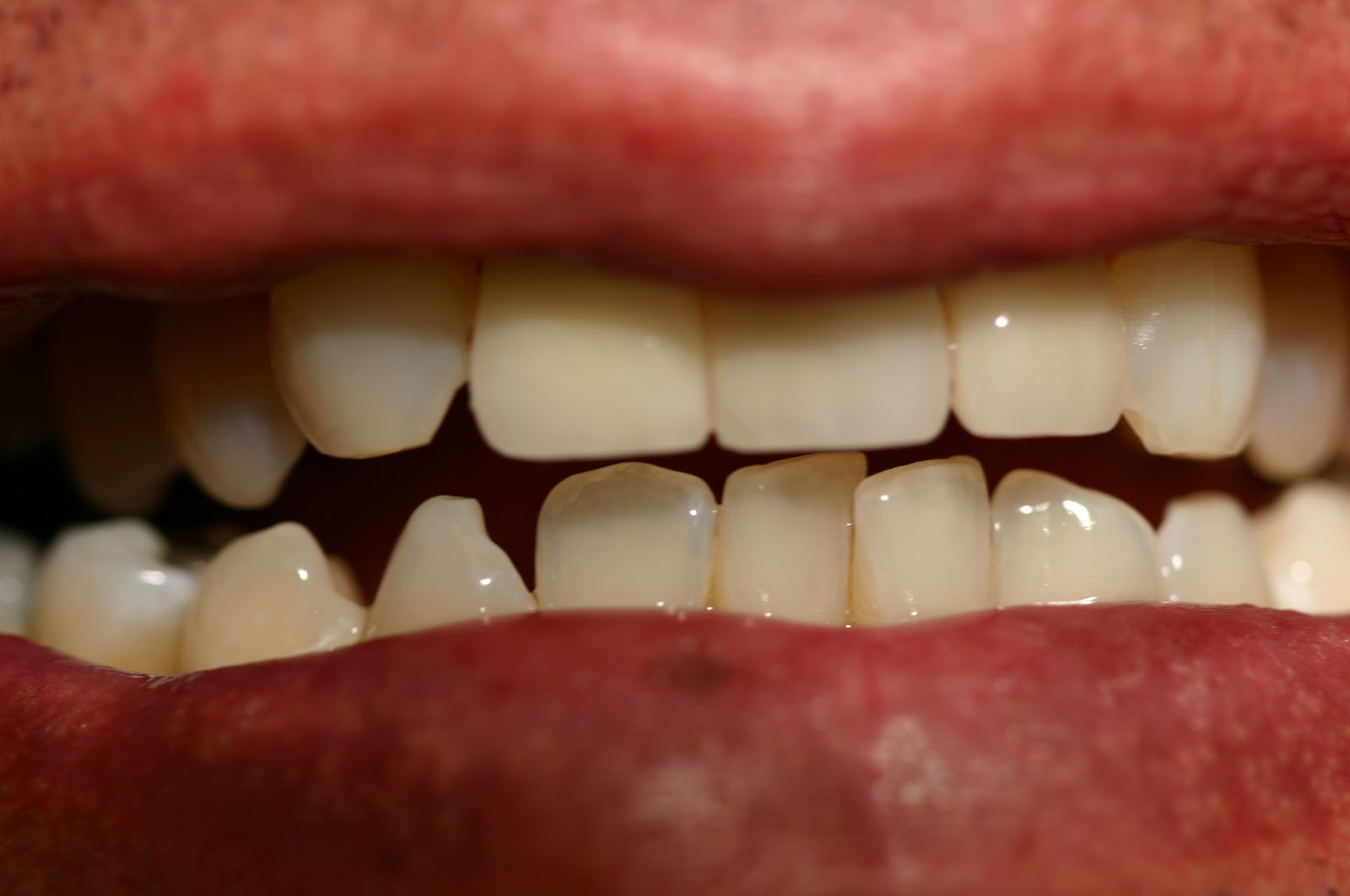 Dr. Robert G. Tupac: Prosthodontics: Porcelain Crowns