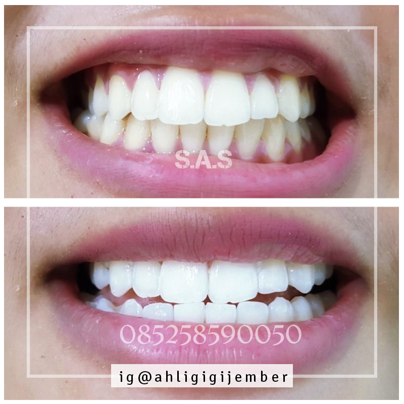 Bleaching! Gigi Putih dan Bersih |Tukang Gigi AHLI GIGI JEMBER