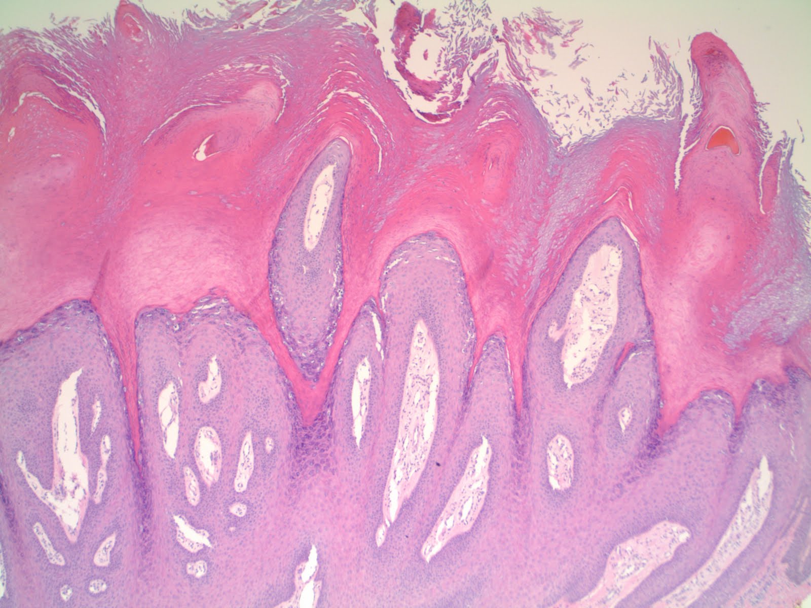 Dermatopathology: Verruca vulgaris