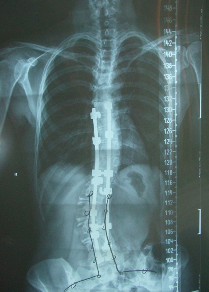 The Not-So-Straight-N-Narrow Path of Scoliosis: My Scoliosis Journey ...