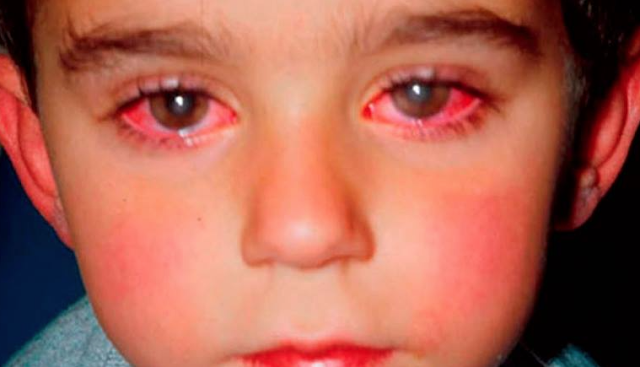 Este niño perdió el 75% de su vista por un juguete que probablemente ...