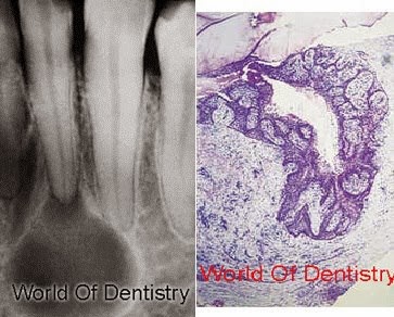 :: World Of Dentistry ::: Radicular Cyst