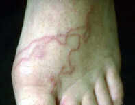 Enfermedades Tropicales: ANQUILOSTOMIASIS