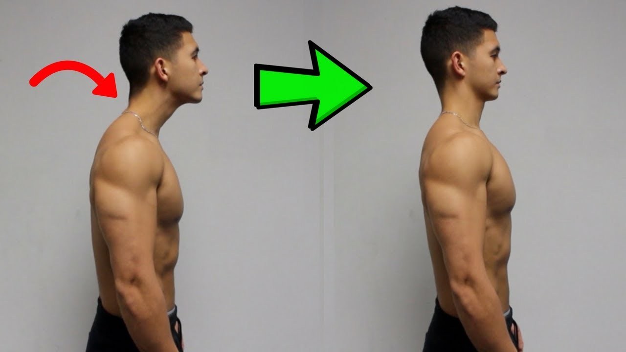 Forward head posture