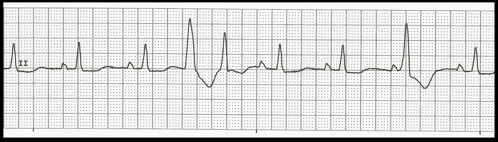 Practice EKG Rhythm Strips 214