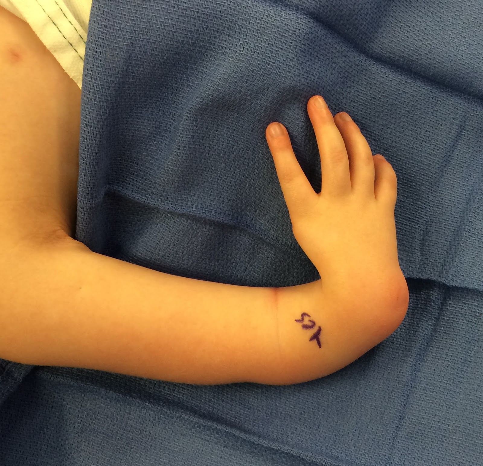 Function in Radial Deficiency | Congenital Hand and Arm Differences ...