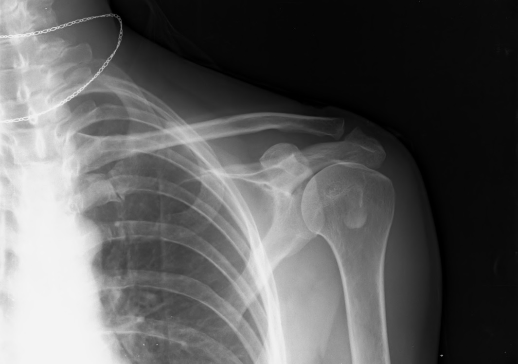 Reumails. Reumatología al día: Imágenes en Reumatología - Lesión ...