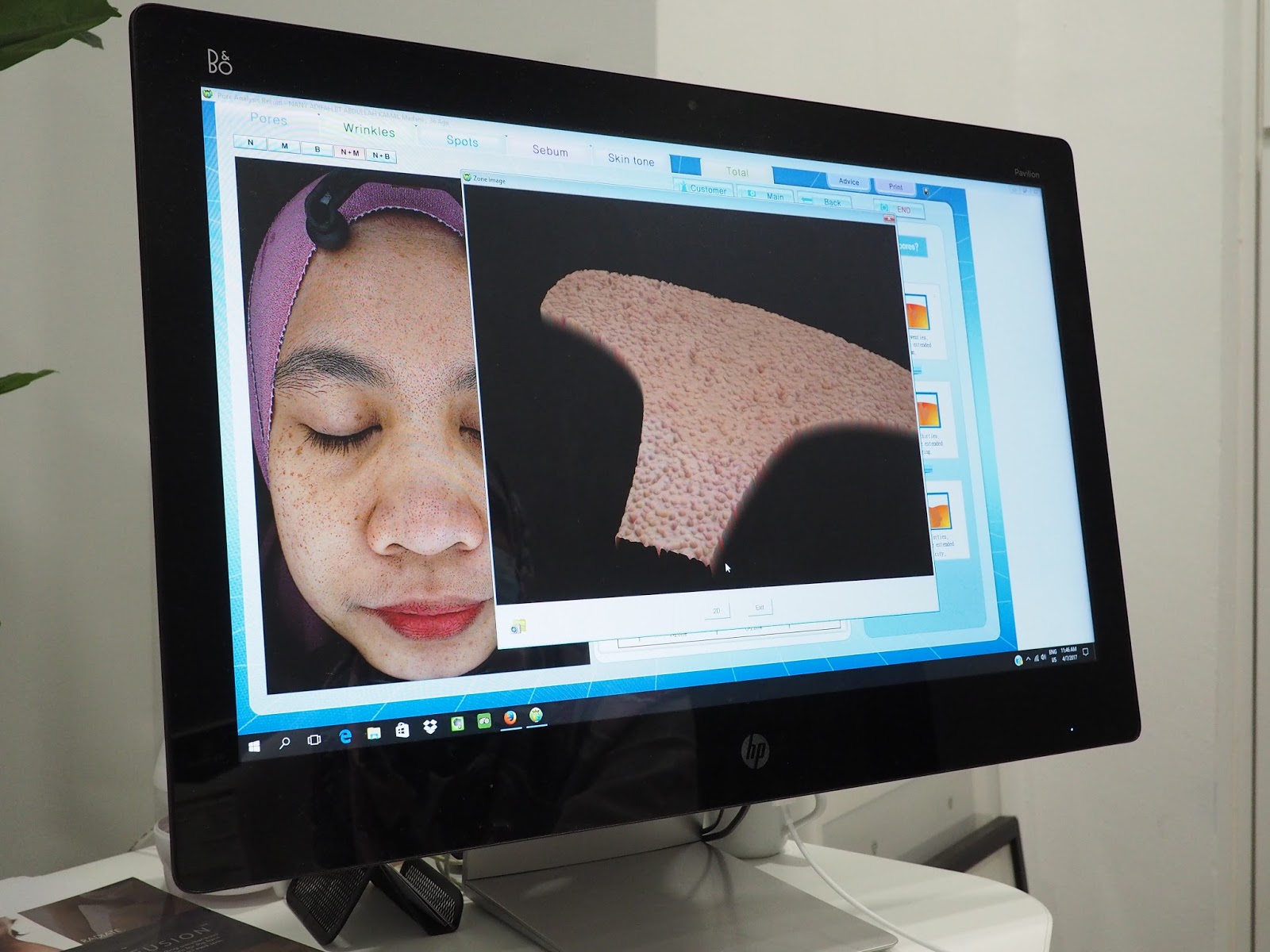 nanyfadhly: Pengalaman Pertama Rawatan Muka di HANNAN MEDISPA DAMANSARA ...