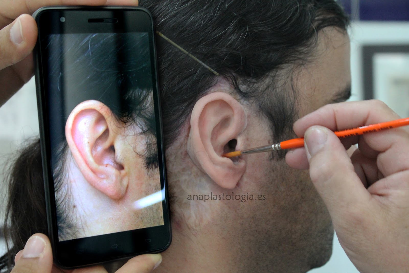 Anaplastologia: Prótesis auricular