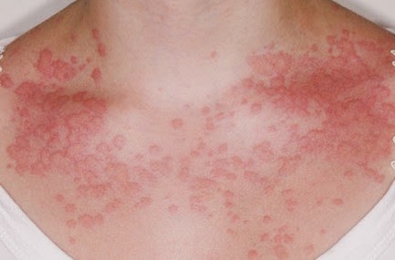 Symptoms gluten intolerance skin rash