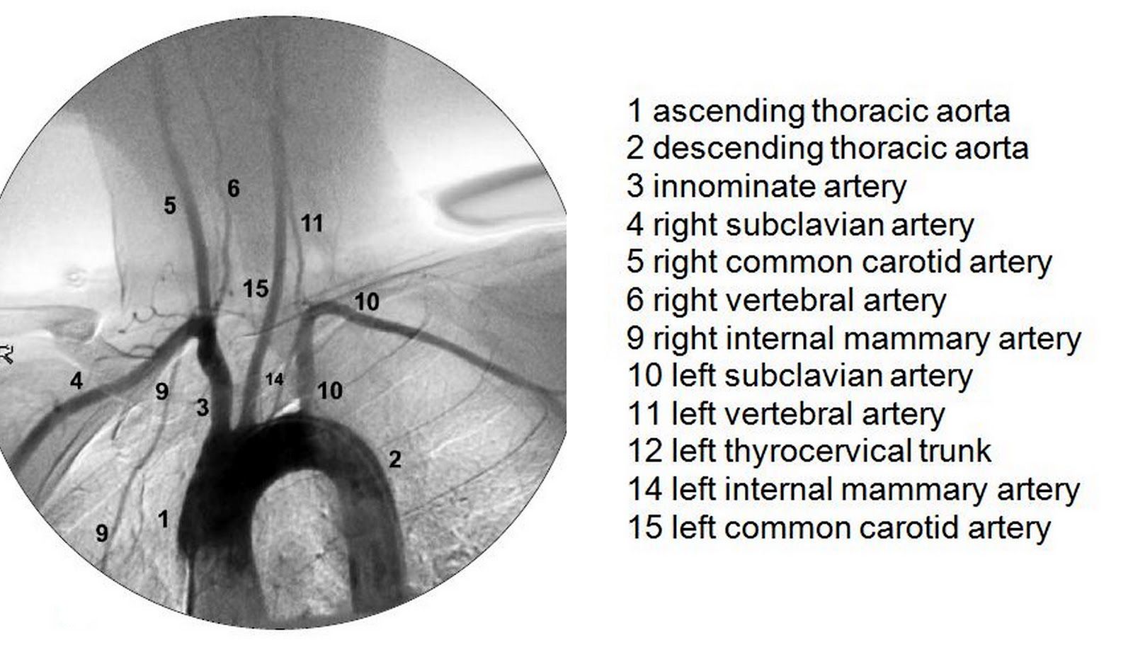 Doctor Man's Blog: 腦血管造影 (DSA cerebral angiogram)
