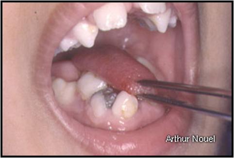 Dentistry lectures for MFDS/MJDF/NBDE/ORE: Developmental Disturbances ...