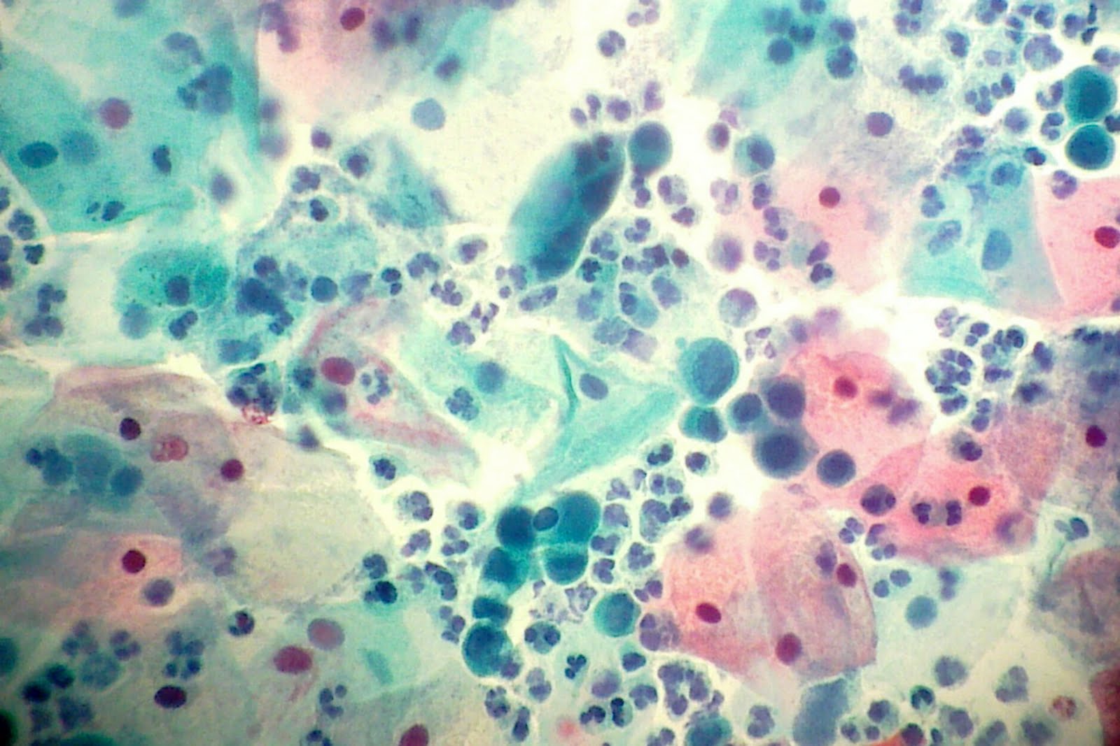 The Cell Hunter Society: Case No. 3 Pap Smear (CP)