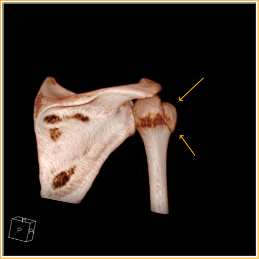 Symmetrical Post Dislocation Greater Tuberosity Fractures-CT ...