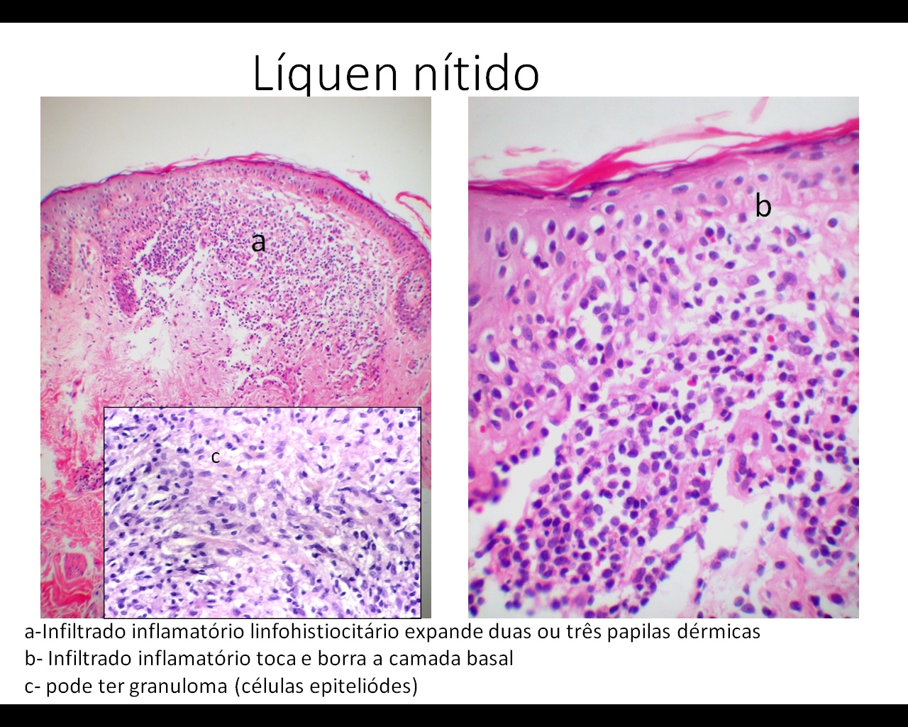 Impetigo Bolhoso Na Virilha - RETOEDU