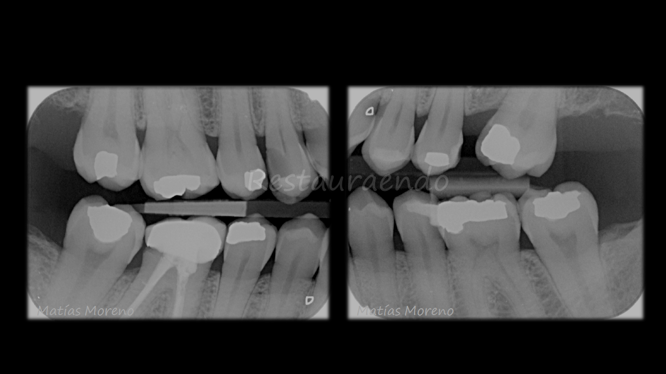 Máster en Odontología Restauradora y Endodoncia: Tratamiento de ...