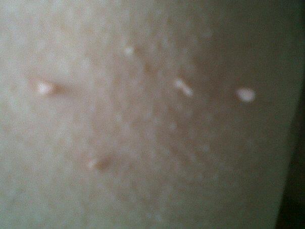 SAPU Dr. Juan Solorzano: Acrocordones