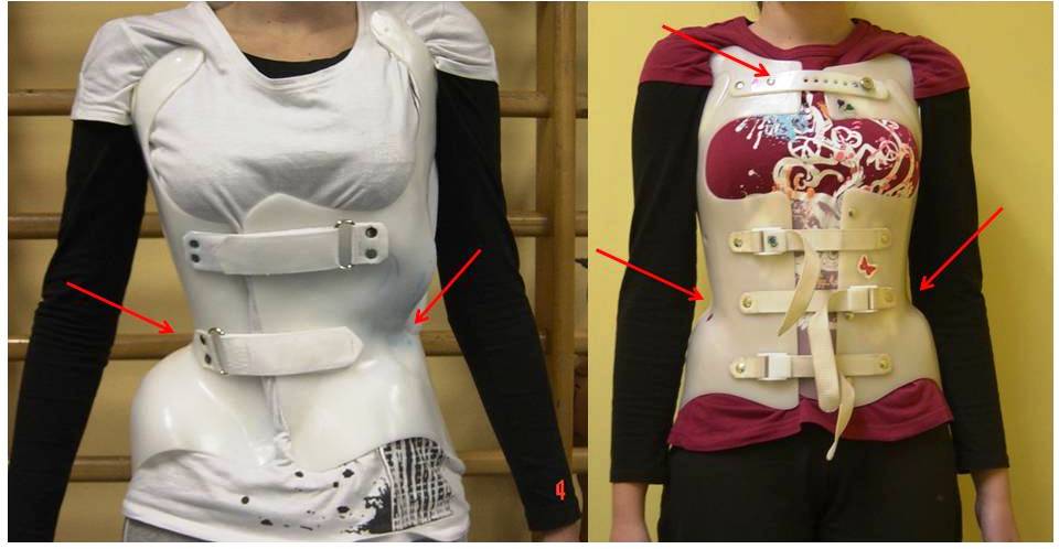Despre corsetul Cheneau :: Corset scolioza / scoliosis braces