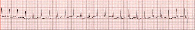 EKG Rhythm Strips 21: Fast rhythms