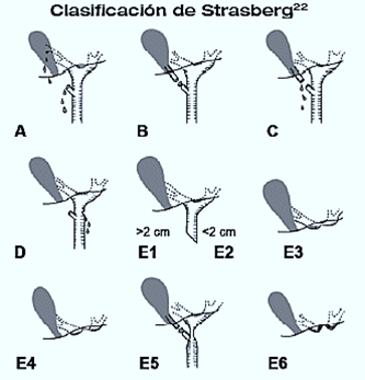MEDICINA: Lesiones Iatrogénicas de la Vía Biliar