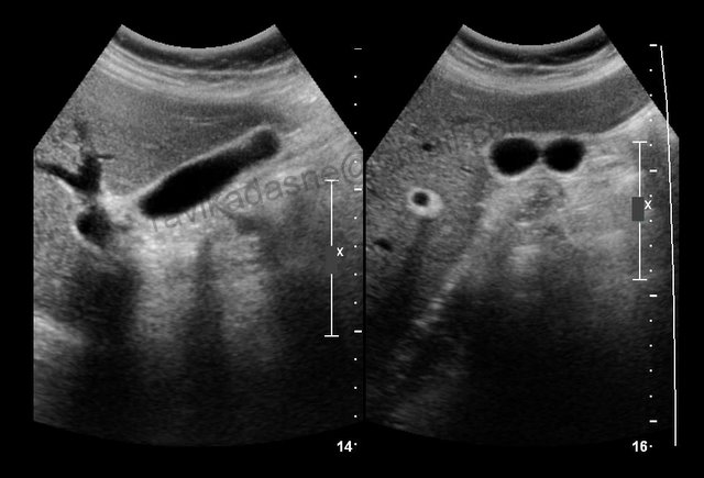 Folded Gallbladder-Ultrasound - Sumer's Radiology Blog