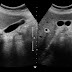 Folded Gallbladder-Ultrasound - Sumer's Radiology Blog