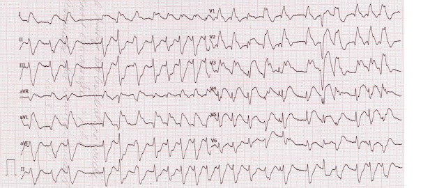 News Klinische Notfall- und Akutmedizin: Fancy EKG - Der heisse Fall ...