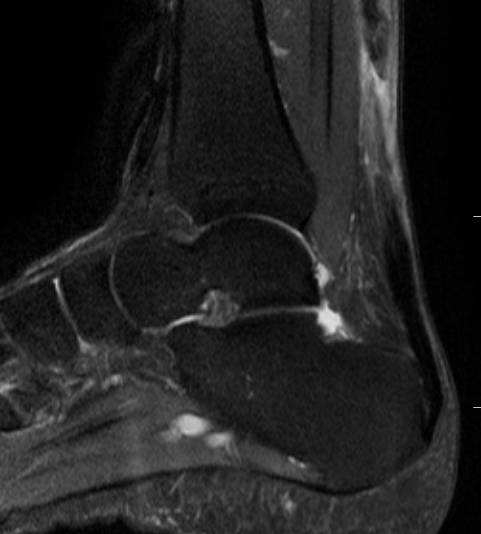 Tendoachilles tear-MRI - Sumer's Radiology Blog