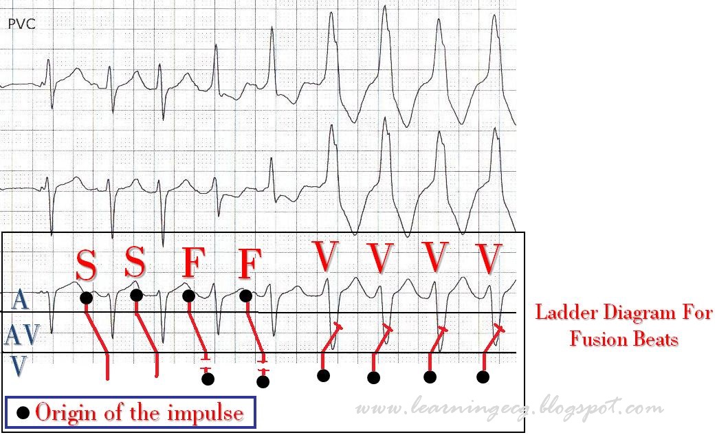ECG Rhythms: Fusion Beats